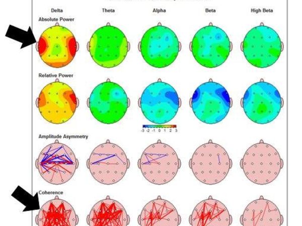 QEEG Testing is the 'GPS' Map of the Brain - Plainview, NY Patch