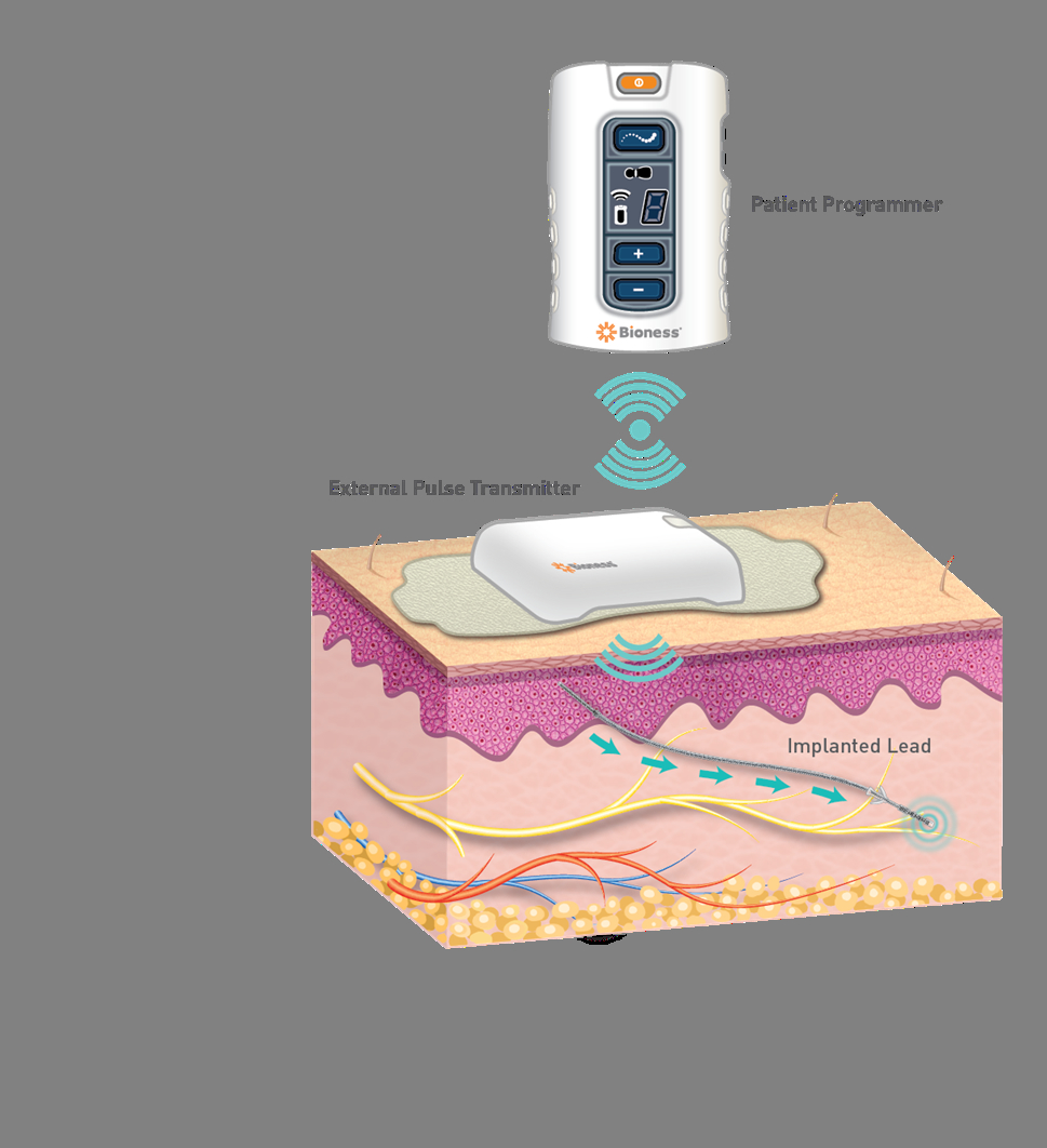 Implant Device Keeps Forest Hills Man Active at 92, Despite Pain ...