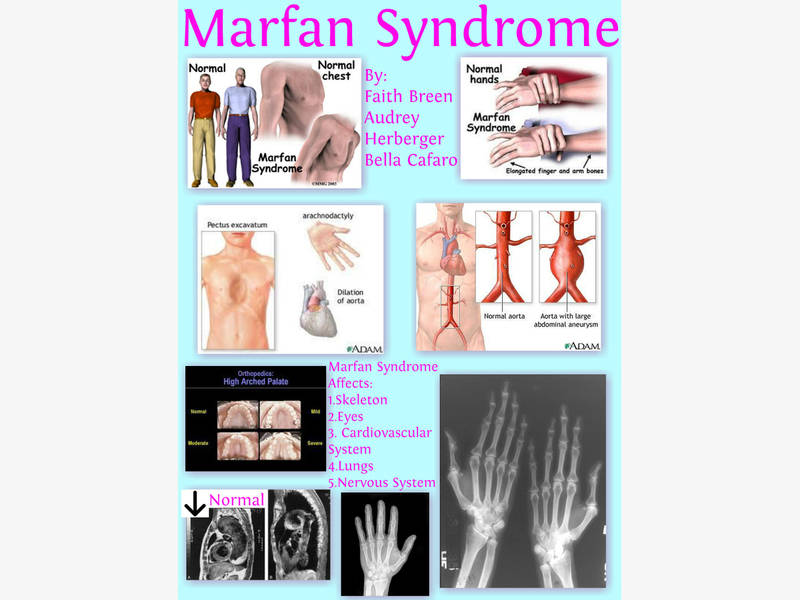 Marfan Syndrome | Arlington, TX Patch